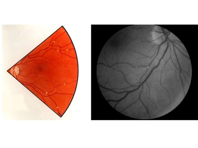 Retinal artery occlusion | PPTX