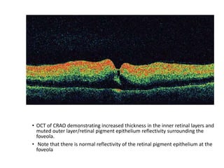 Retinal artery occlusion | PPTX