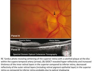 Retinal artery occlusion | PPTX