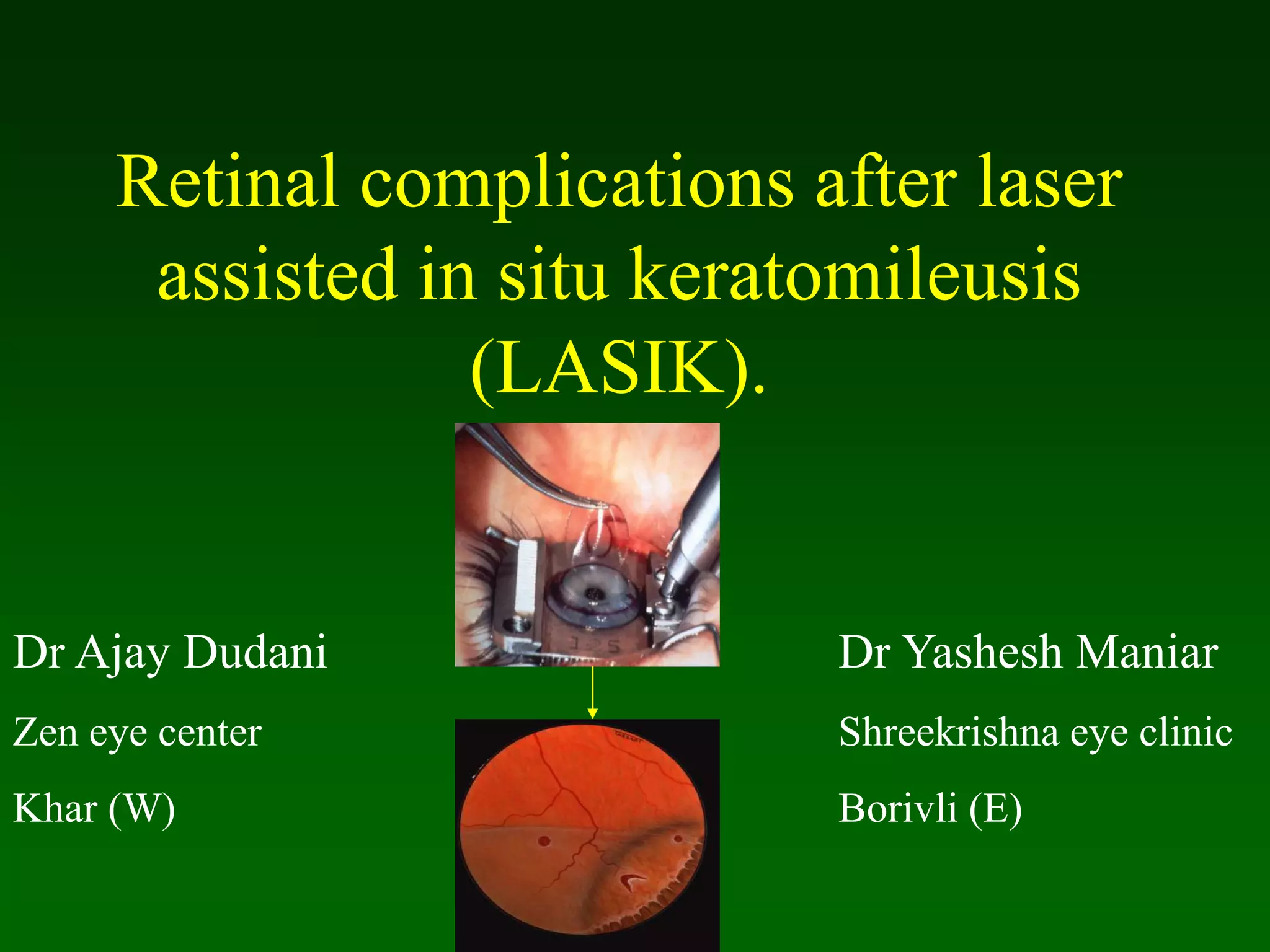 Retinal complications of LASIK- DR AJAY DUDANI | PPT