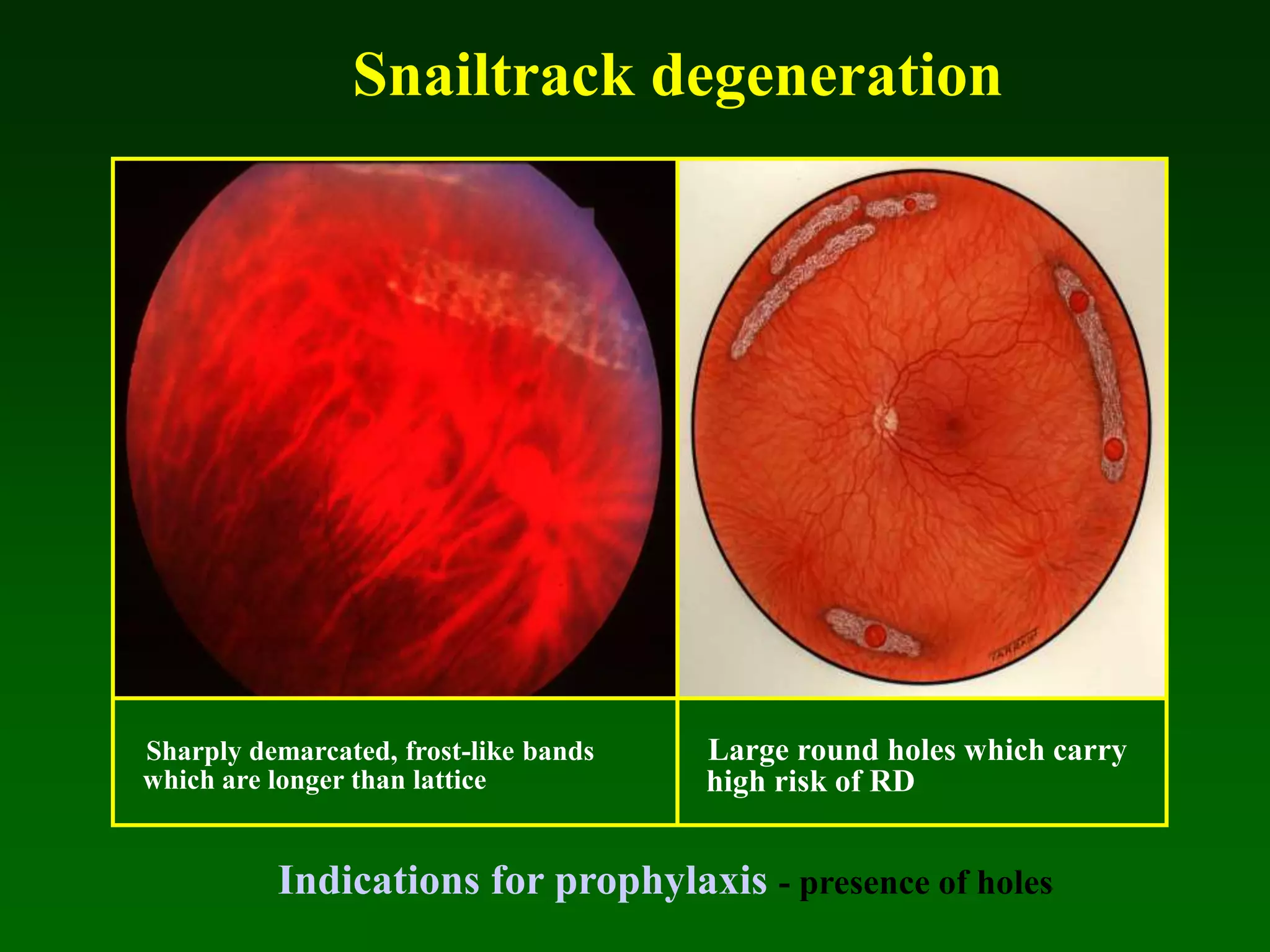 Retinal complications of LASIK- DR AJAY DUDANI | PPT