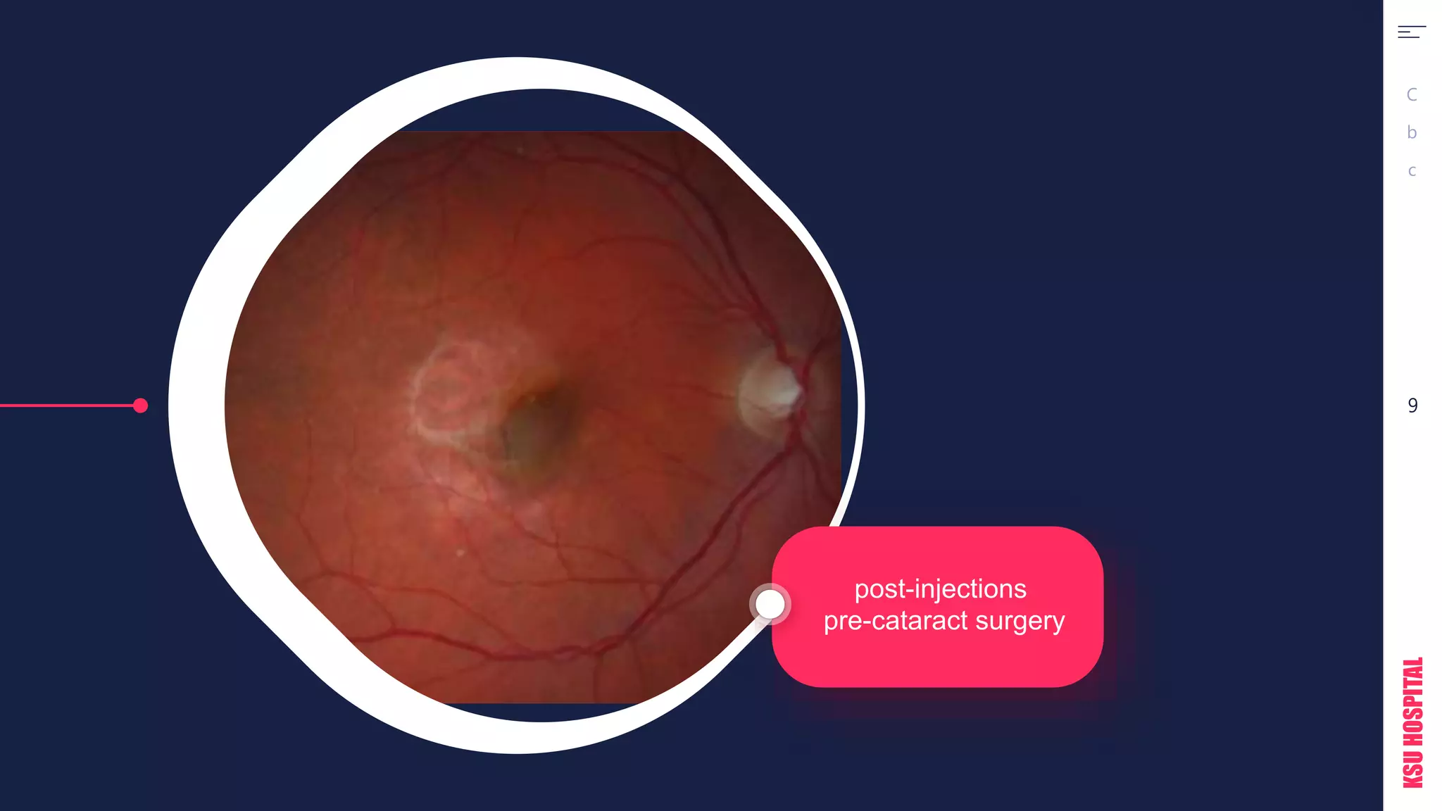 Retinal consideration in cataract surgery.pptx