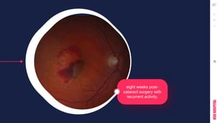 Retinal consideration in cataract surgery.pptx