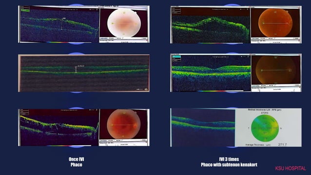 Retinal consideration in cataract surgery.pptx