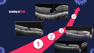 Retinal consideration in cataract surgery.pptx