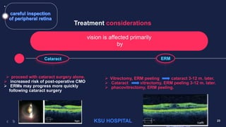 Retinal consideration in cataract surgery.pptx