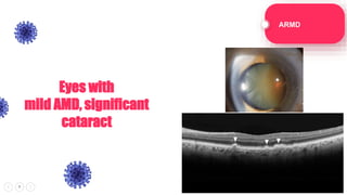 Retinal consideration in cataract surgery.pptx