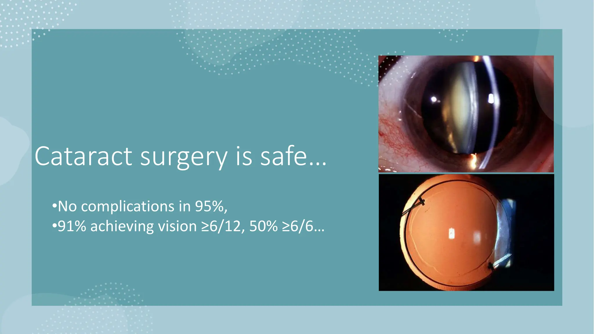 Retinal consideration in cataract surgery | PPTX