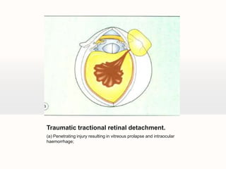Retinal detachment | PPTX