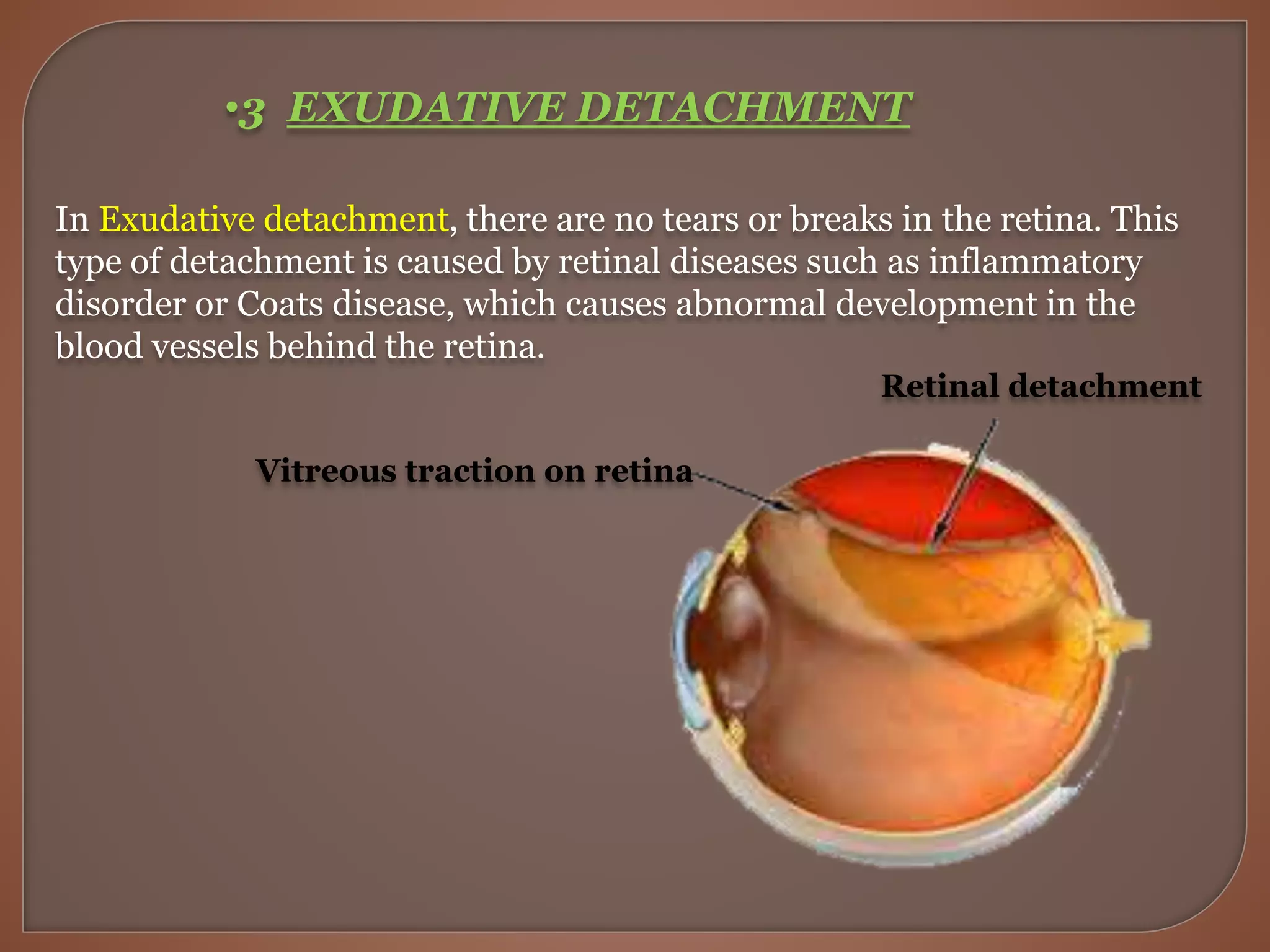Retinal detachment | PPT