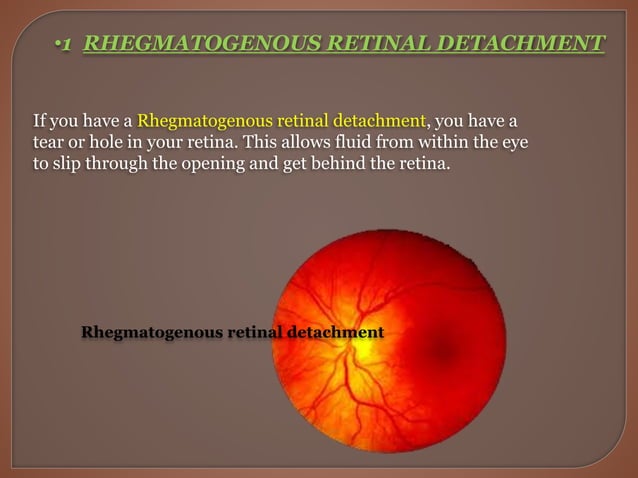 Retinal detachment | PPT