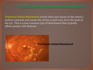 Retinal detachment | PPT