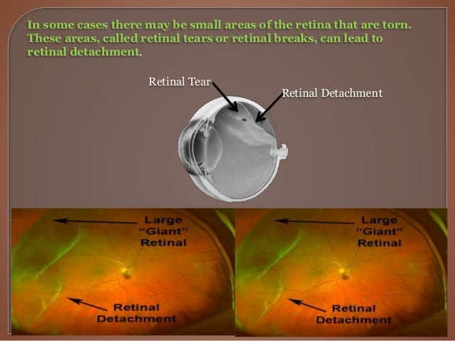 Retinal detachment