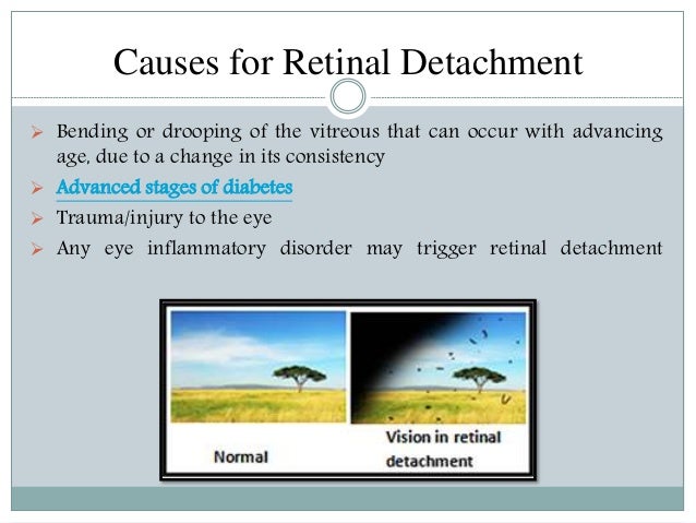Retinal Detachment: Causes, Symptoms, Diagnosis and Treatment.