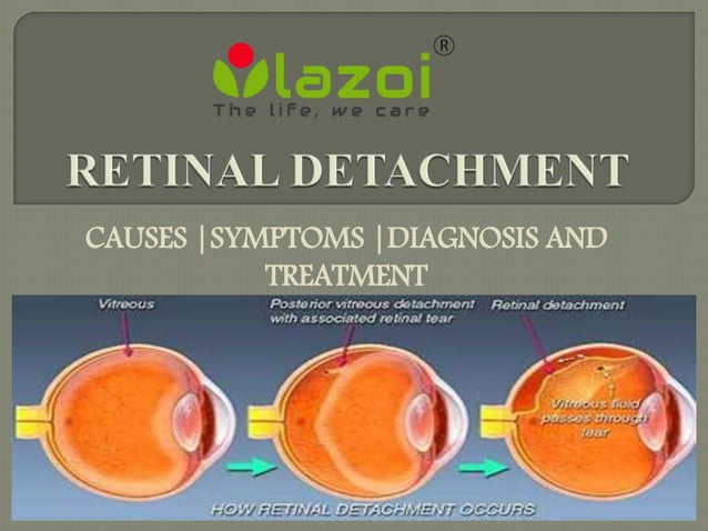 Retinal detachment : Causes, symptoms and treatment | PPT