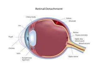 Retinal detachment | PPT