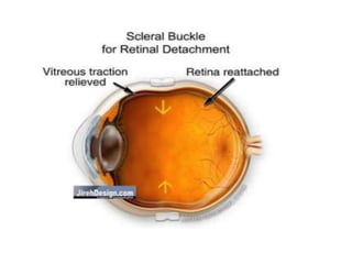 Retinal detachment | PPT