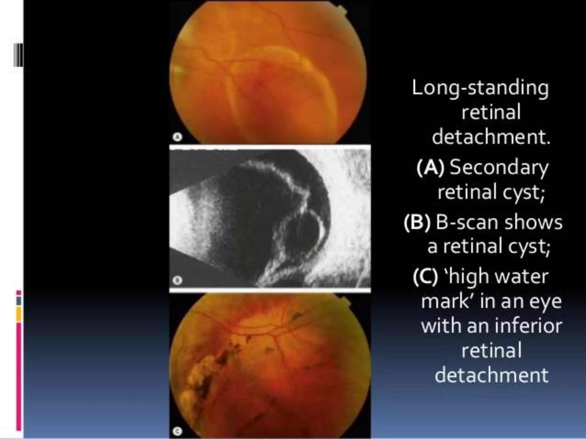 RHEGMATOGENOUS Retinal detachment | PPTX