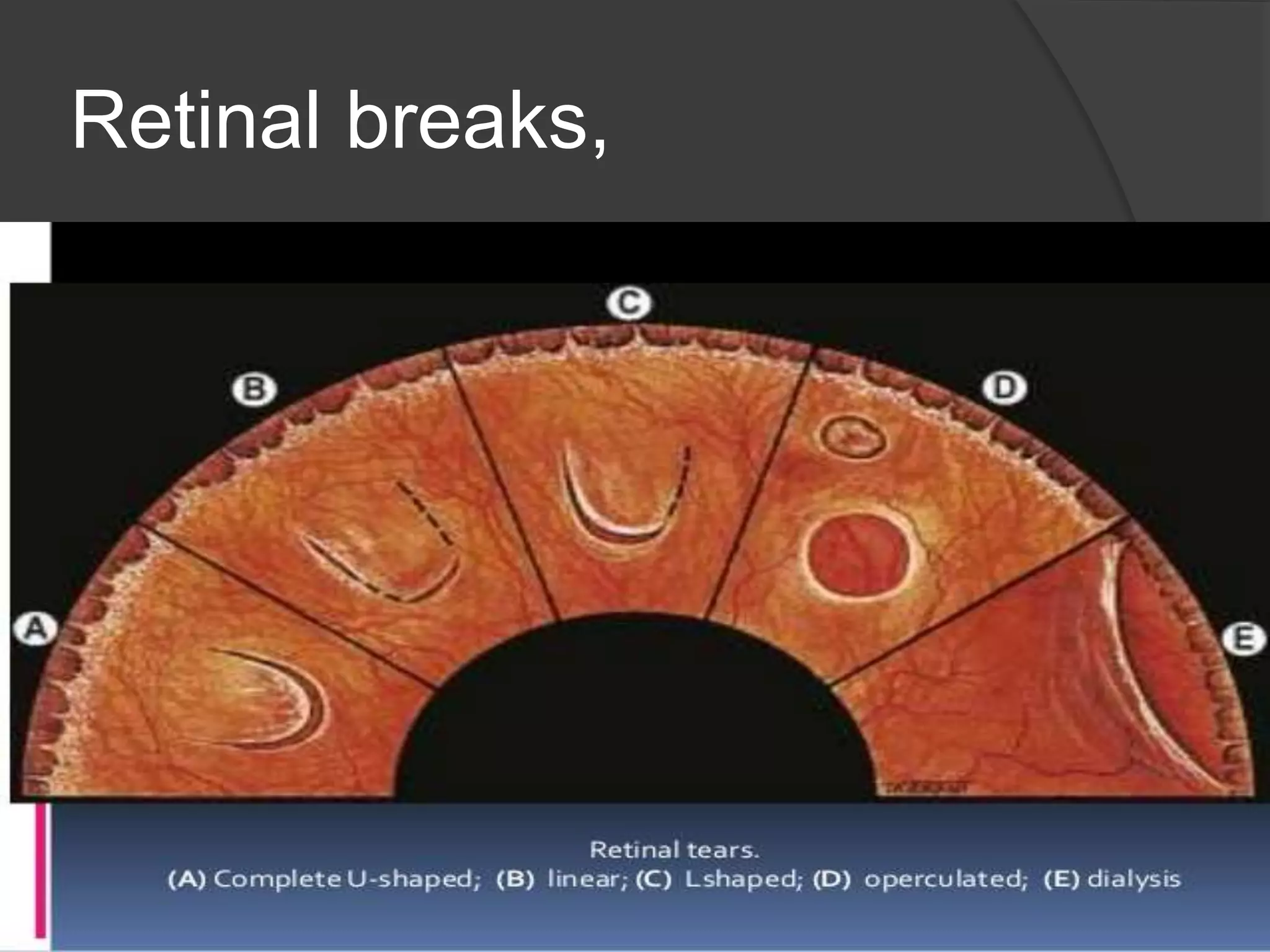 RHEGMATOGENOUS Retinal detachment | PPTX