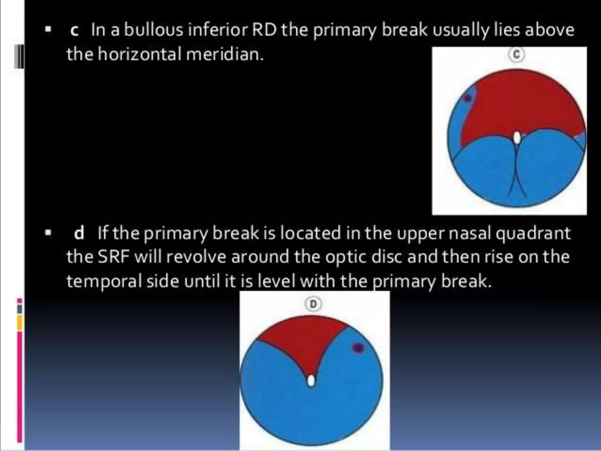 RHEGMATOGENOUS Retinal detachment | PPTX
