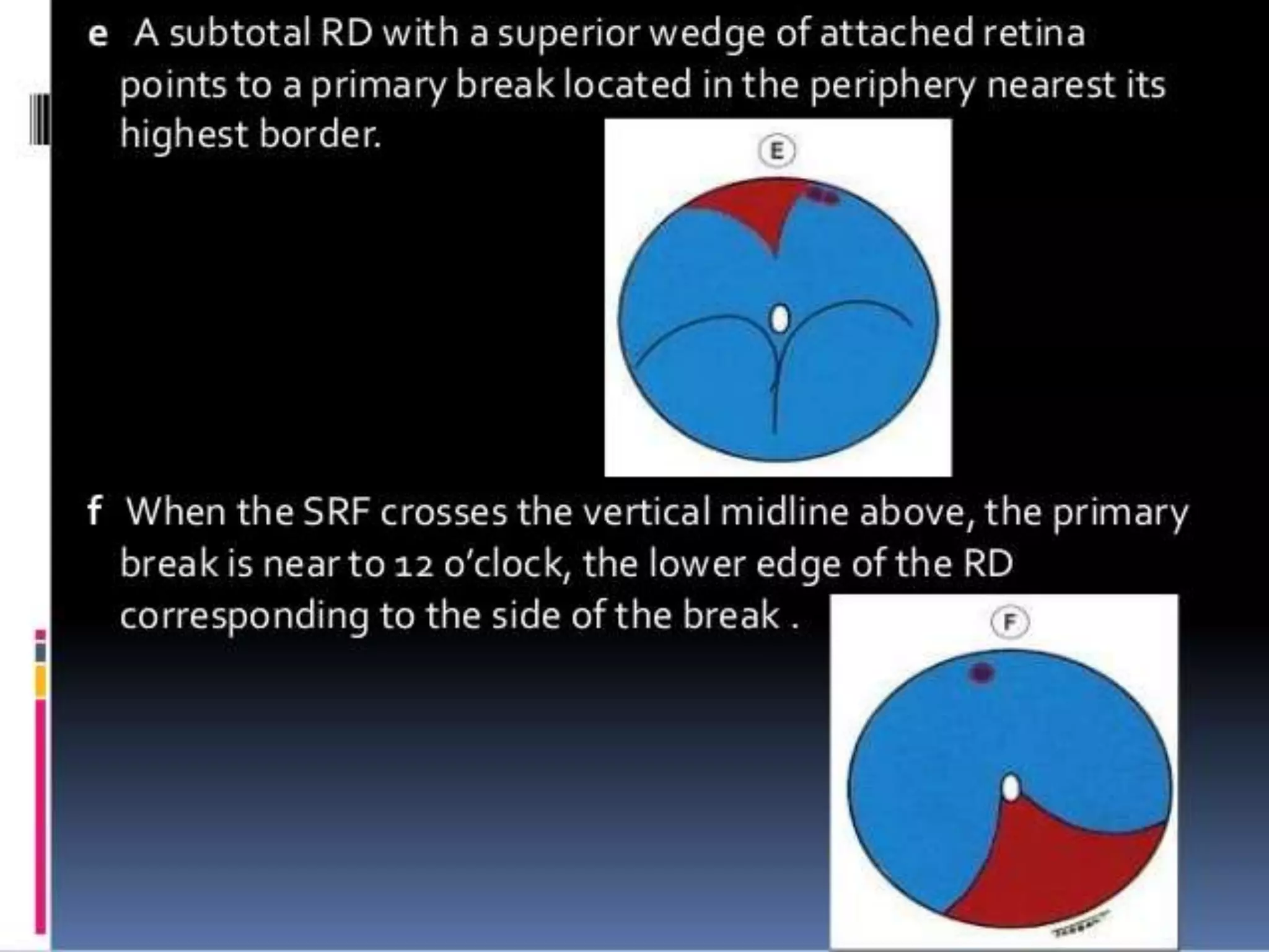 Rhegmatogenous Retinal Detachment Ppt