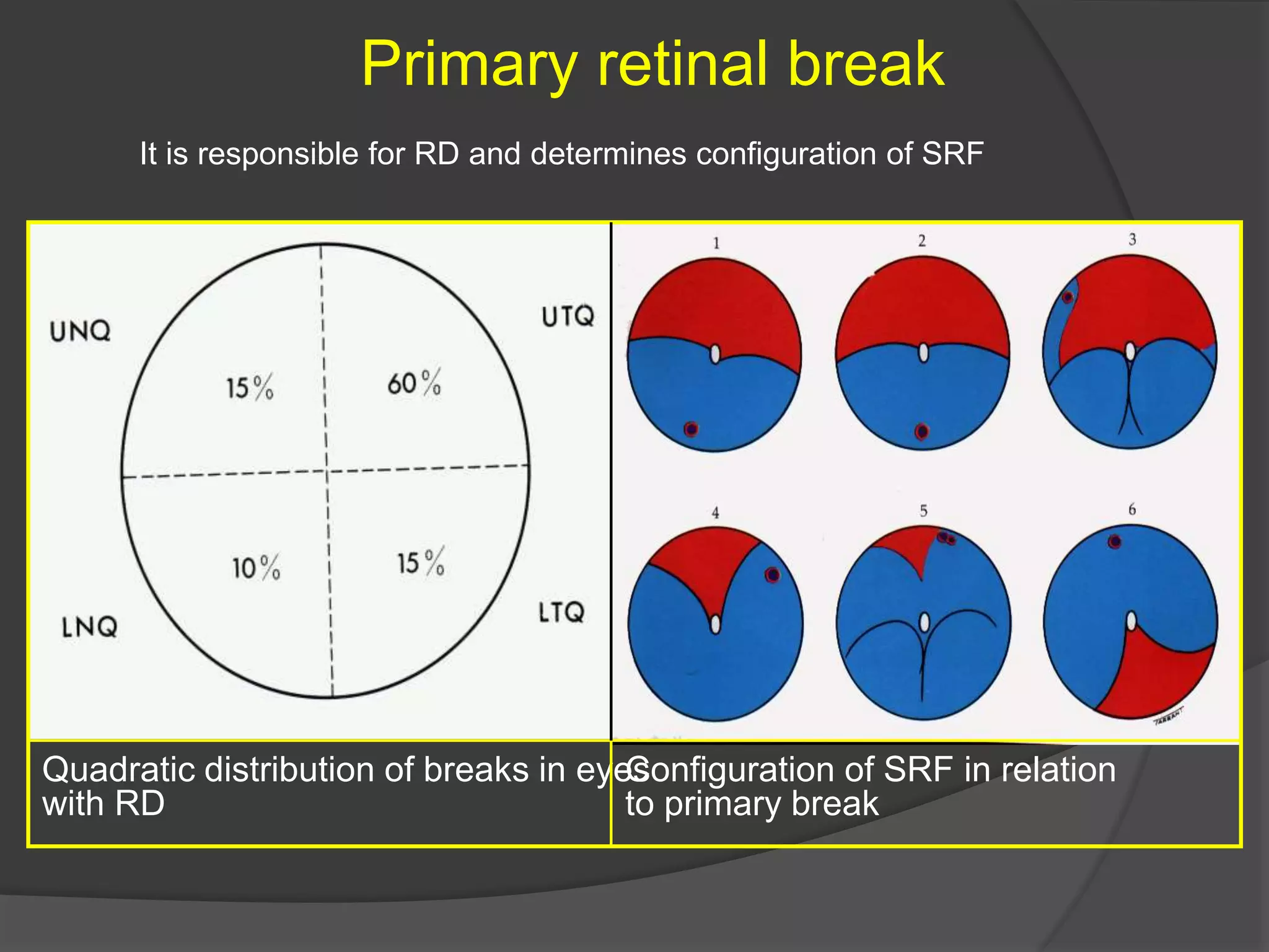 RHEGMATOGENOUS Retinal detachment | PPTX