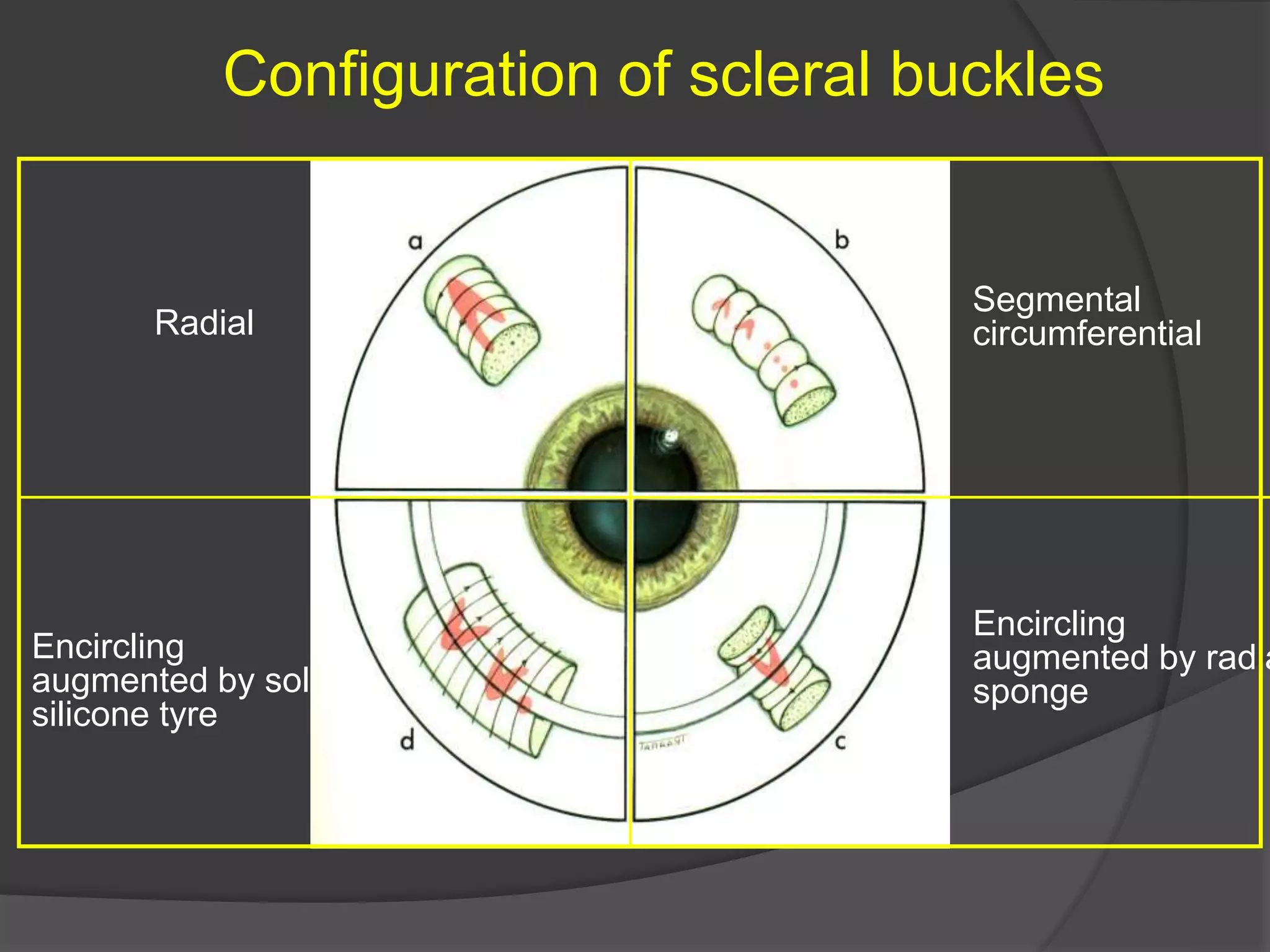 RHEGMATOGENOUS Retinal detachment | PPTX