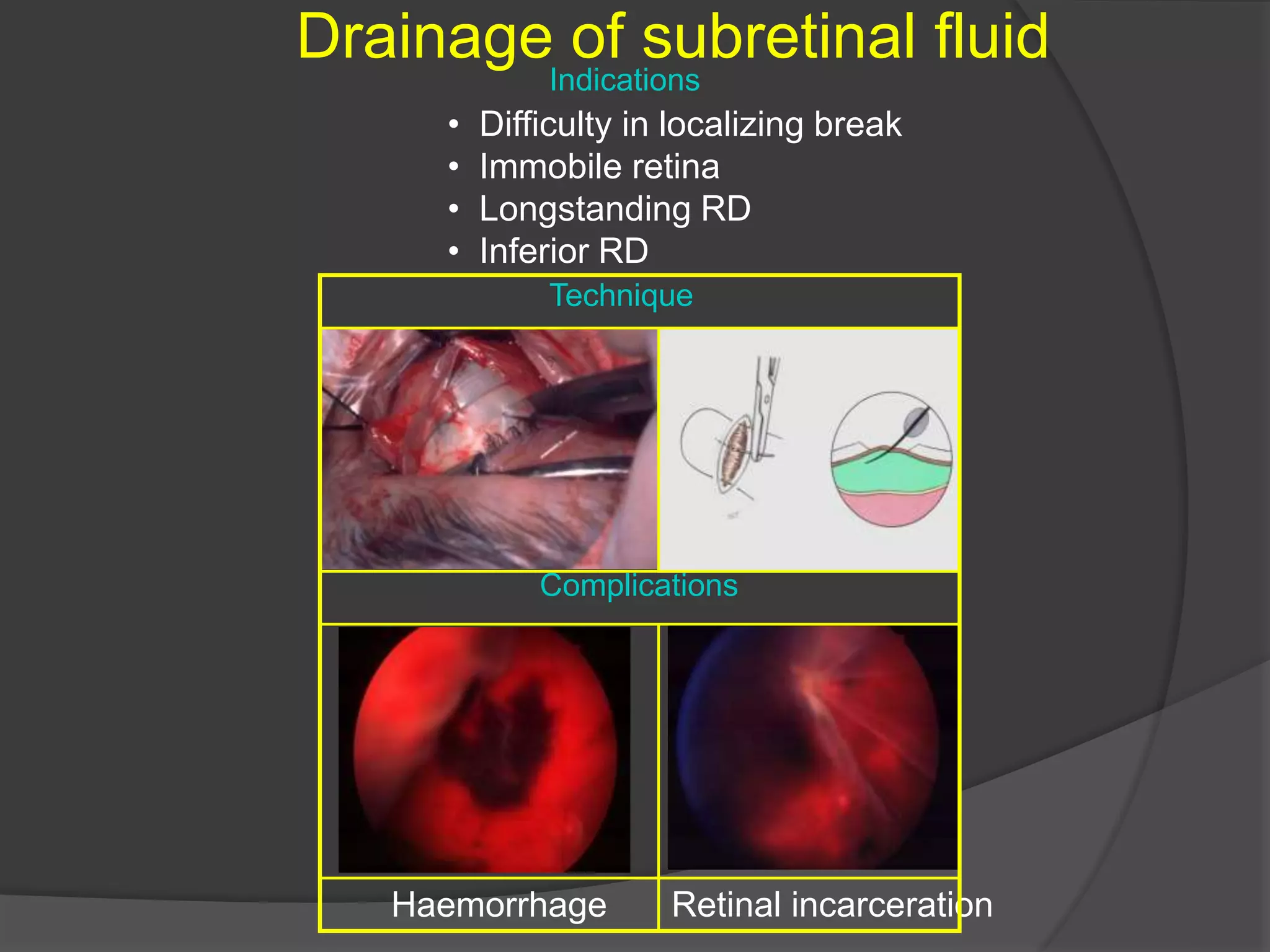 RHEGMATOGENOUS Retinal detachment | PPTX