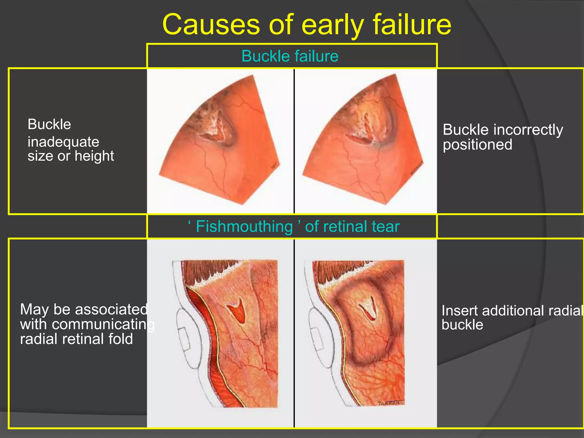 RHEGMATOGENOUS Retinal detachment | PPTX
