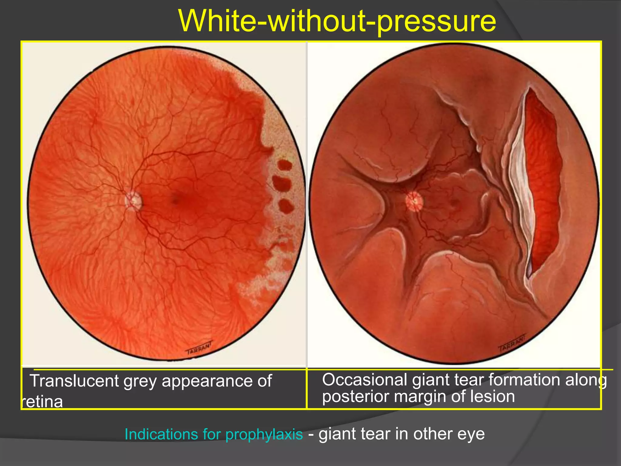 RHEGMATOGENOUS Retinal detachment | PPTX