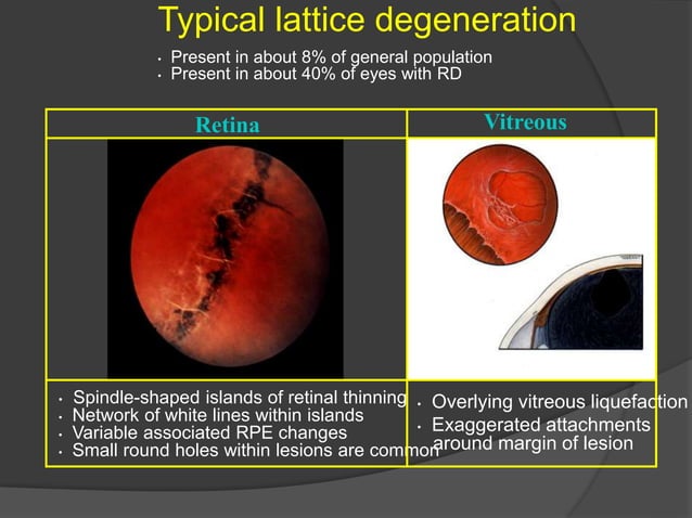 RHEGMATOGENOUS Retinal detachment | PPTX