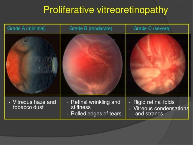 RHEGMATOGENOUS Retinal detachment