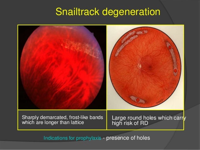 RHEGMATOGENOUS Retinal detachment