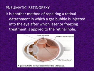 Retinal detachment | PPT