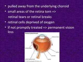 Retinal detachment | PPT