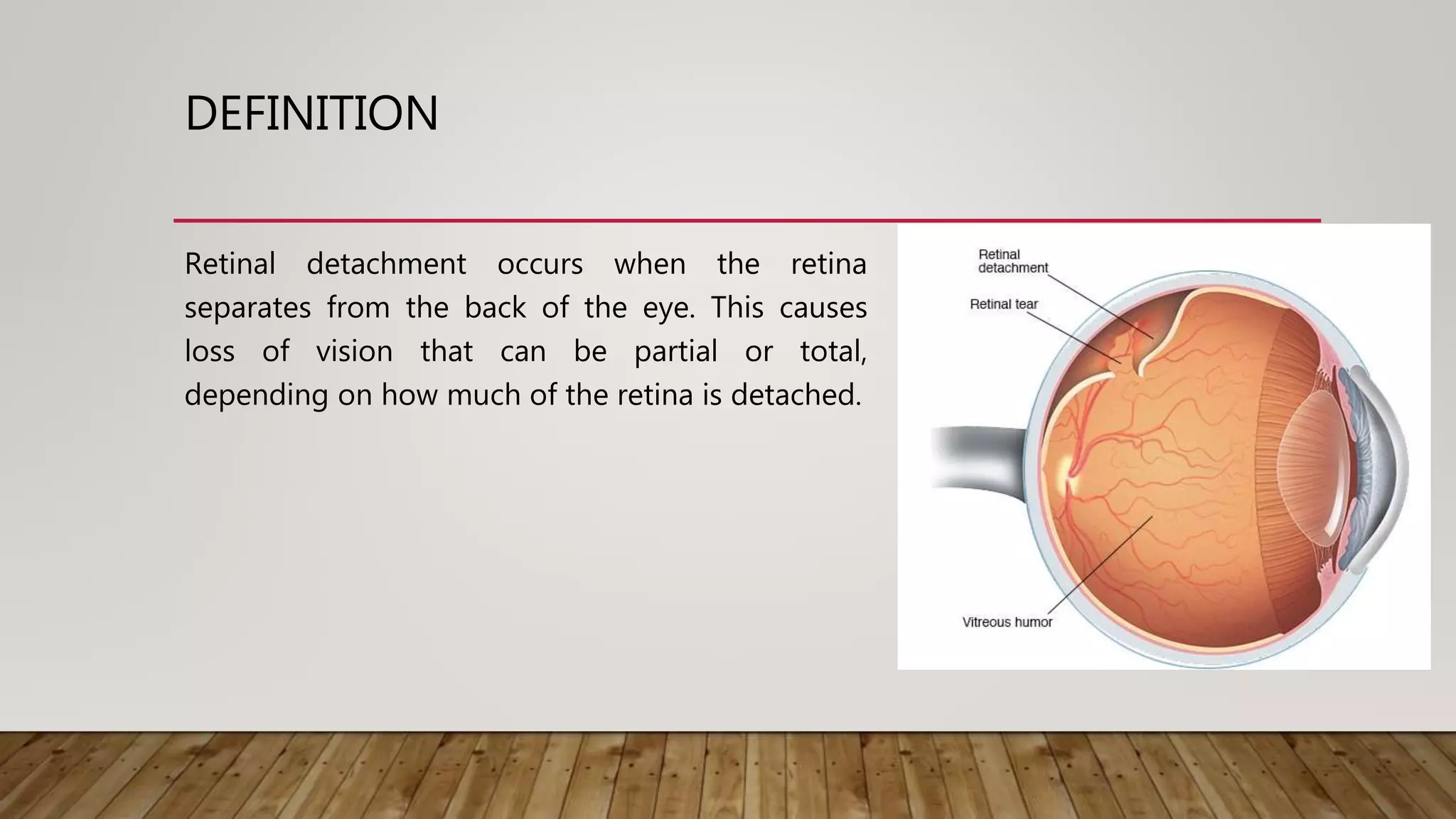 Retinal Detachment | PPTX