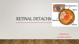 Retinal Detachment | PPTX