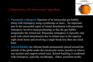 Retinal detachment | PDF