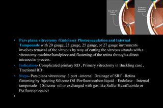 Retinal detachment | PDF