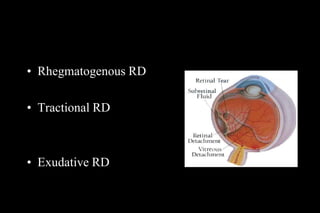 Retinal detachment | PDF