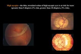 Retinal detachment | PDF