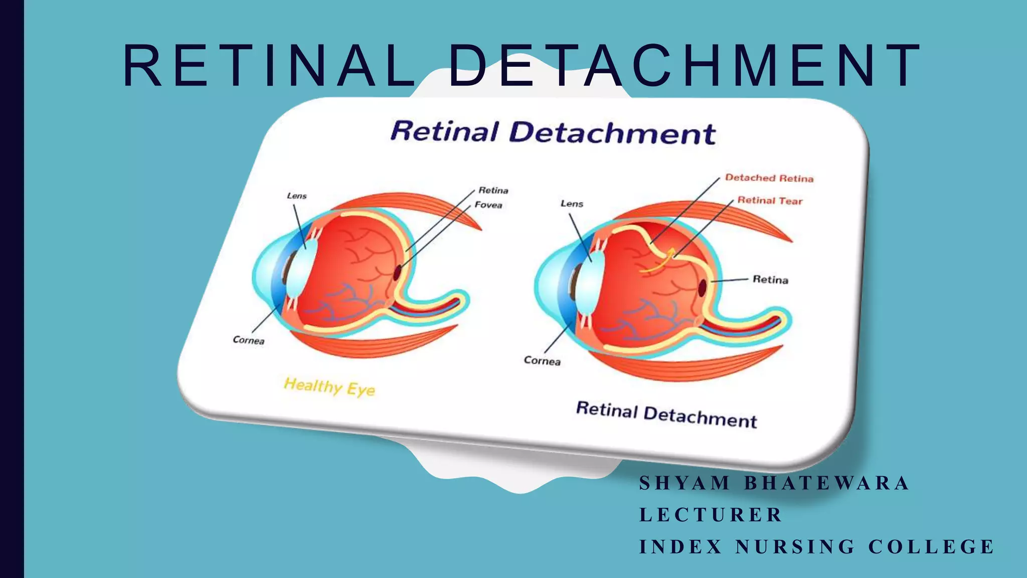 Retinal detachment | PPTX