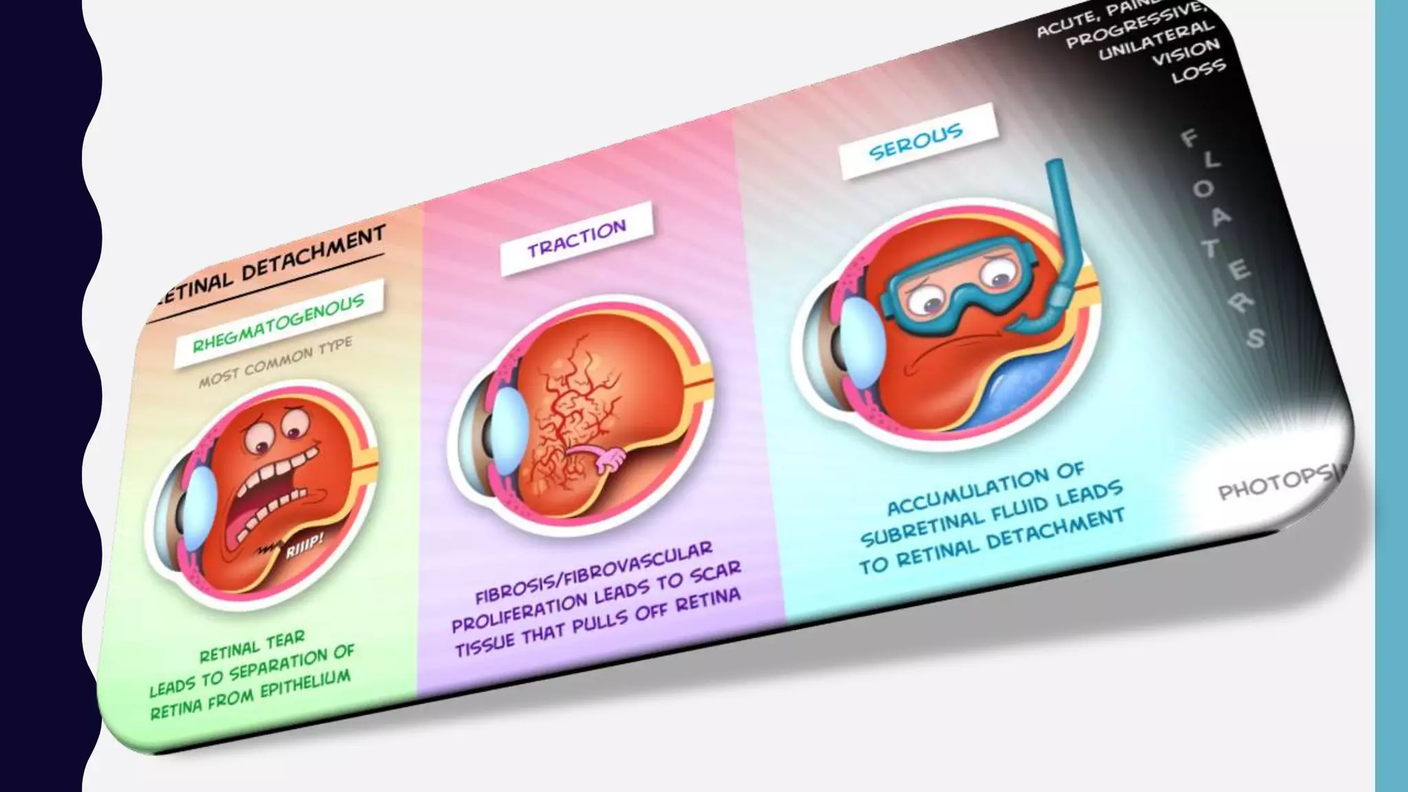 Retinal detachment | PPTX