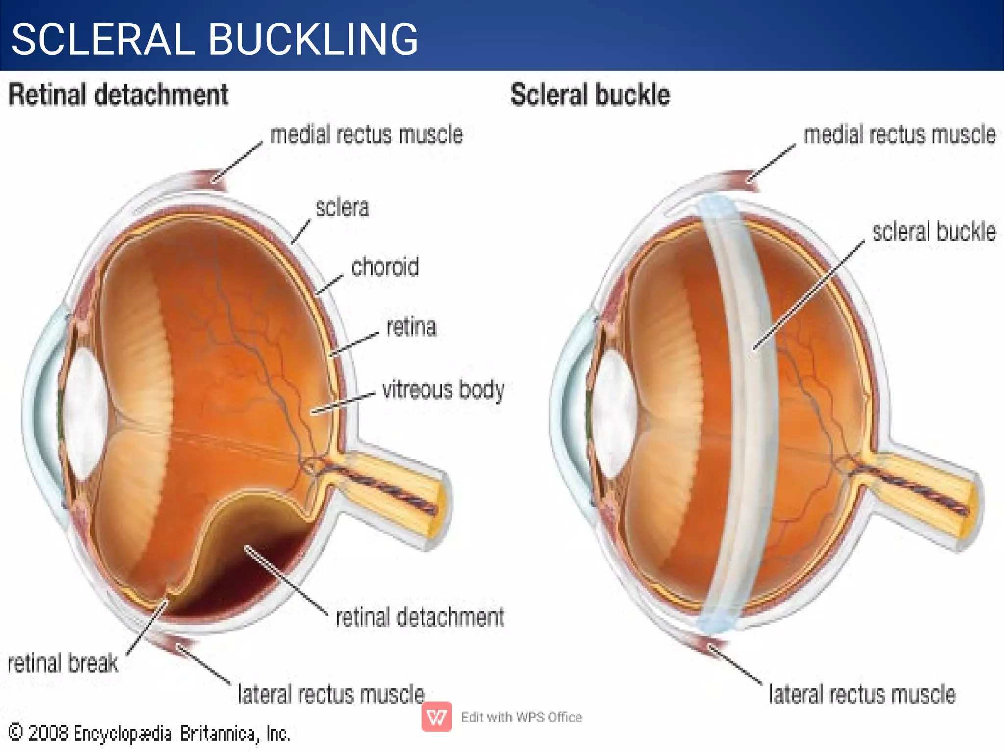 Retinal detachment presentation | PDF