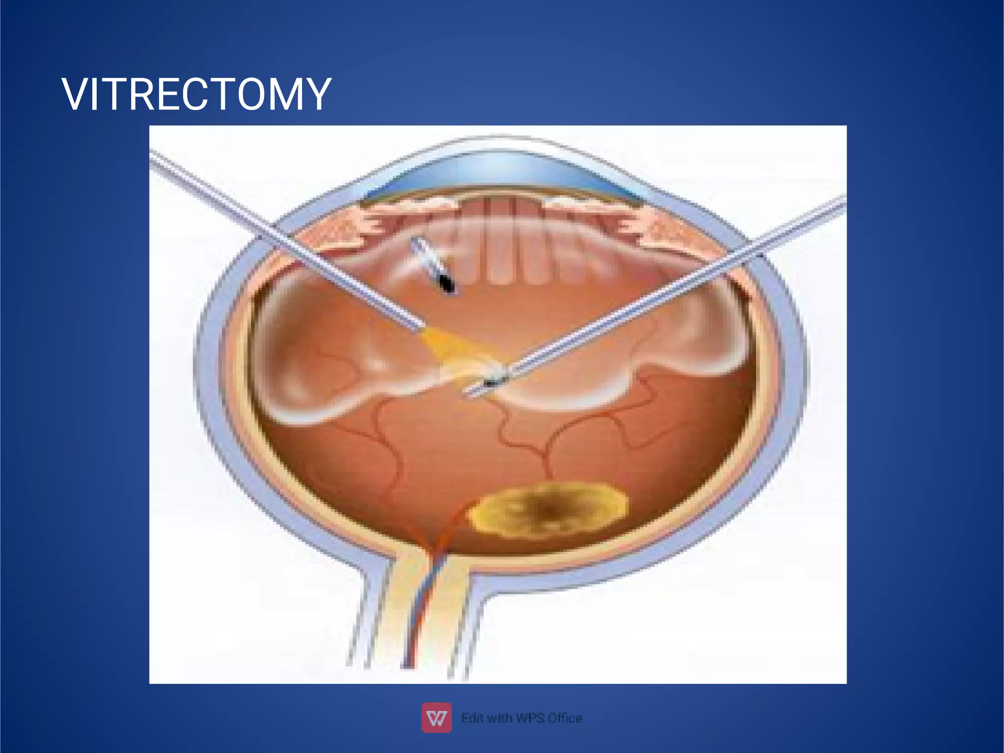 Retinal detachment presentation | PDF