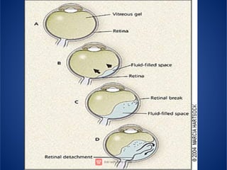 Retinal detachment presentation | PDF