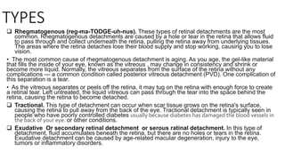 Retinal detachment | PPTX