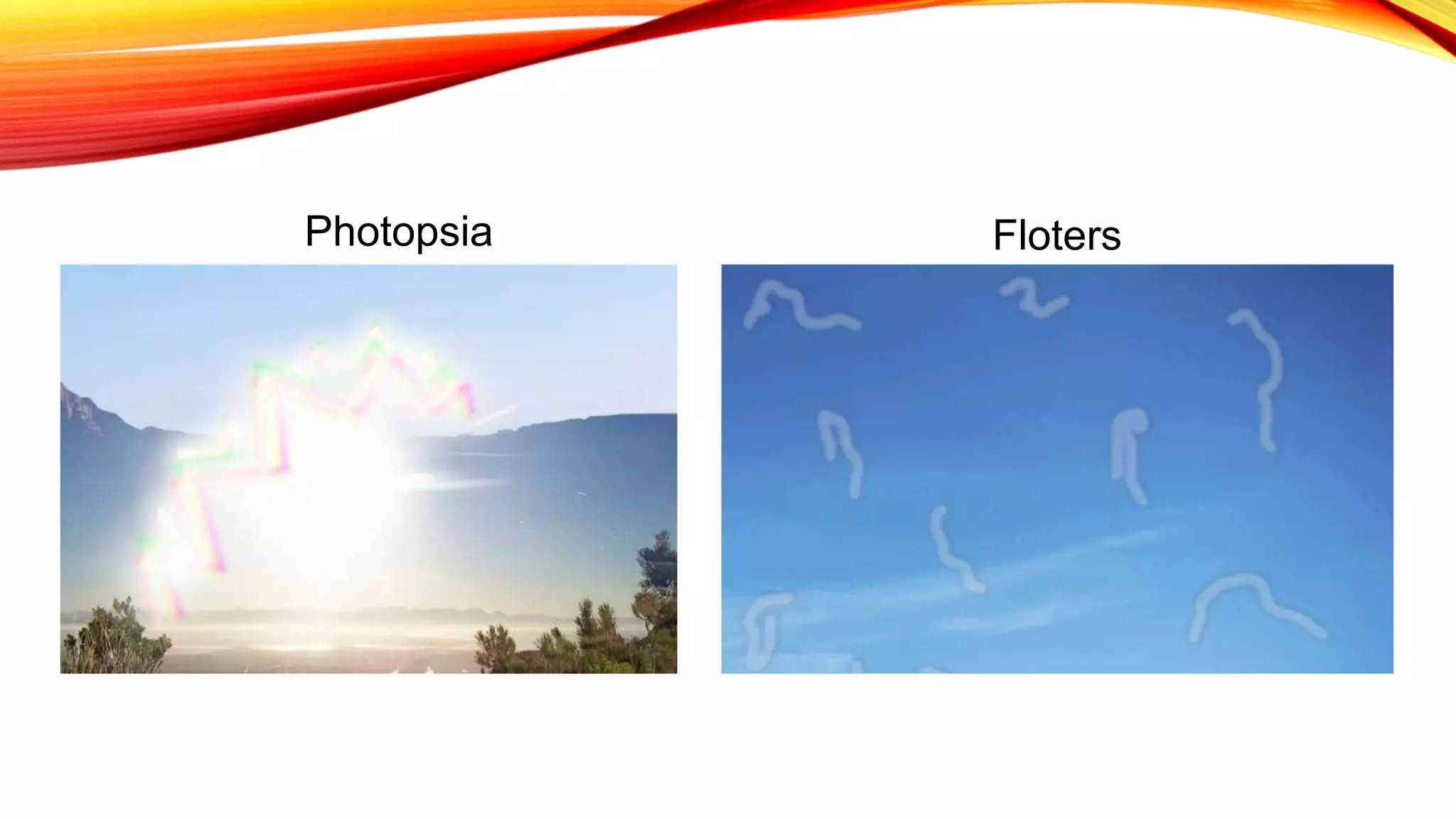 Retinal detachment | PPTX