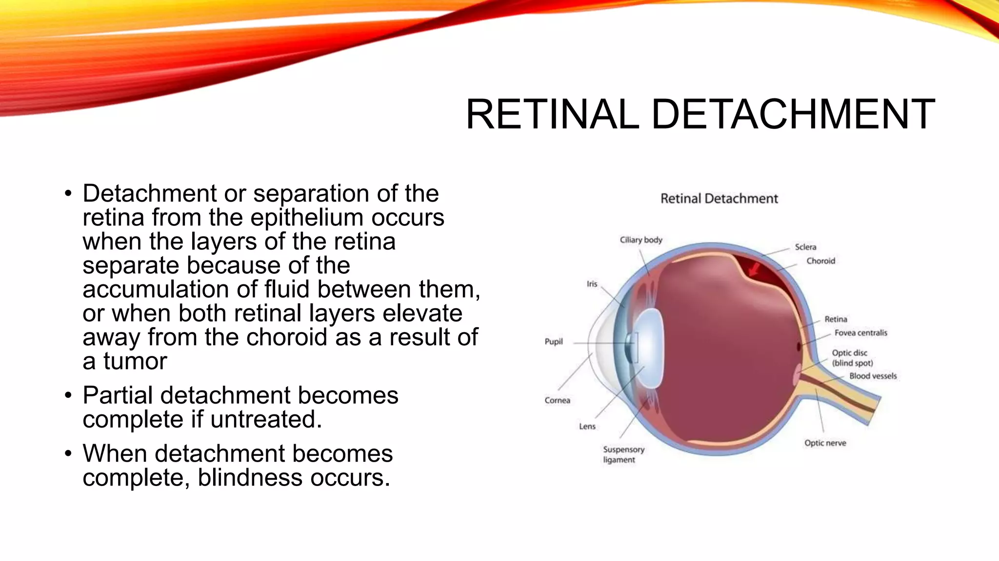 Retinal detachment | PPTX