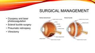 Retinal detachment | PPTX